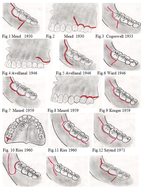 tipos de incisiones quirurgicas en odontologia pdf tipos de incisiones quirurgicas en odontologia pdf